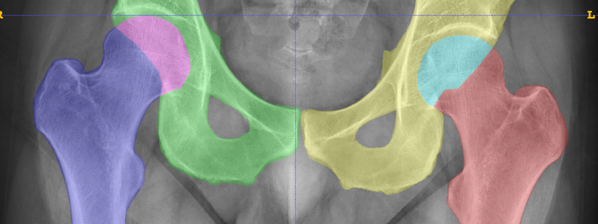 Image Segmentation: What It Is and How It's Used in Orthopedics